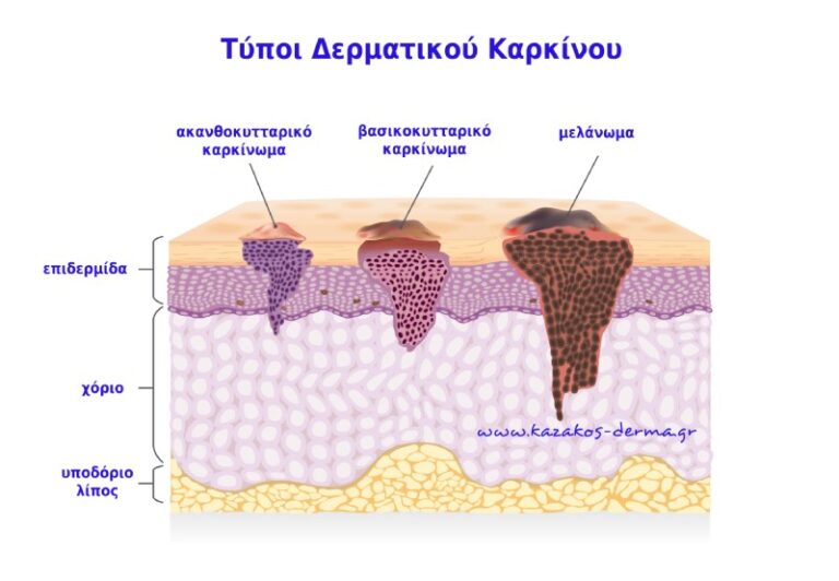 Καρκίνος δέρματος - Χαραλάμπος Καζάκος